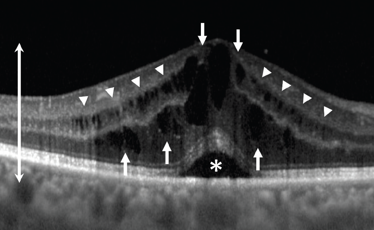OCT Biomarkers in Uveitic Macular Edema - Retina Today