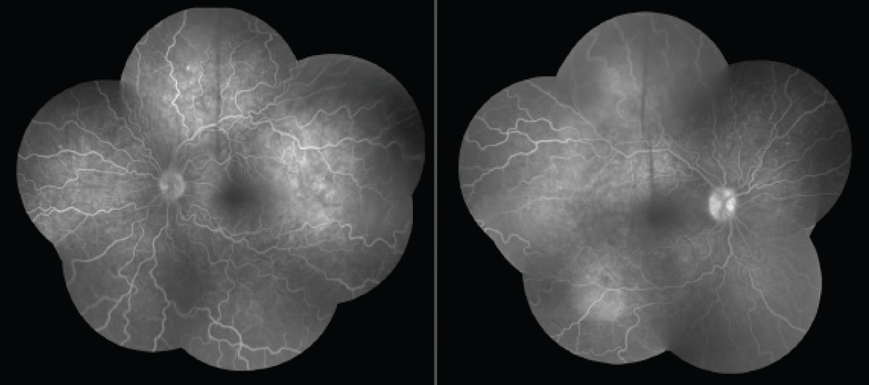 Uveitis for Rural Retina Gurus - Retina Today