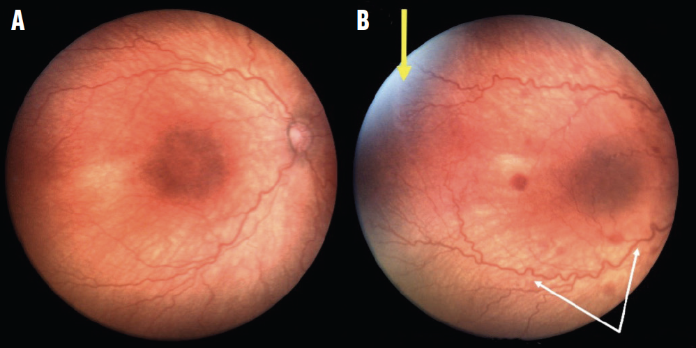 ICROP3 Updates: Reactivation and Regression - Retina Today