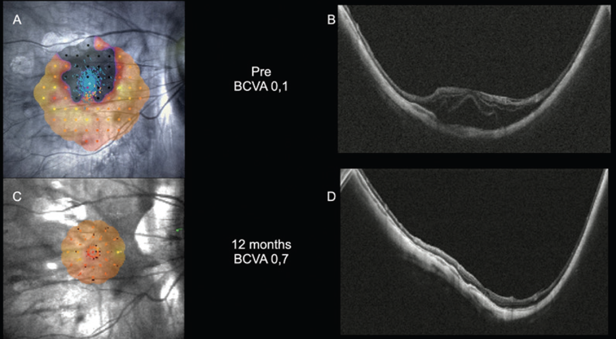 Manage Myopic Traction Maculopathy With Ease - Retina Today
