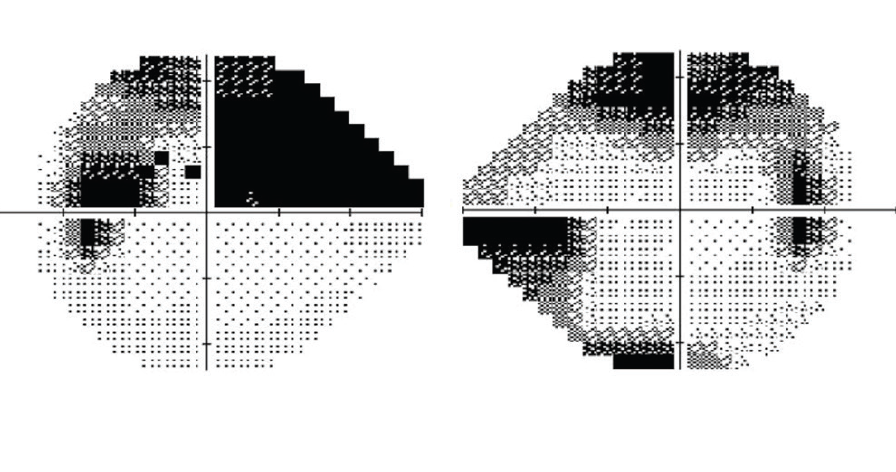 To Treat or Not to Treat - Glaucoma Today