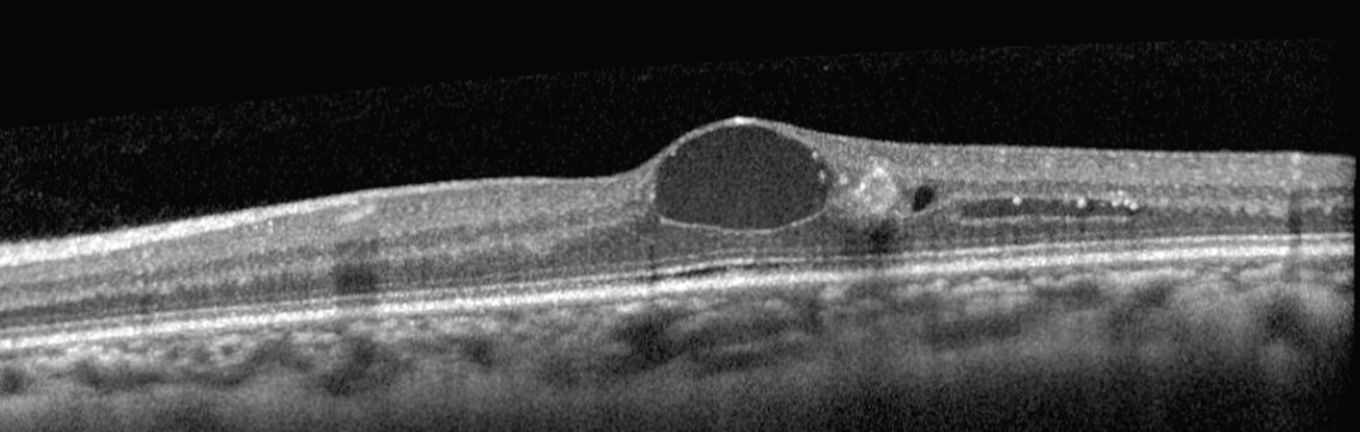 Diabetic Eye Disease: When to Intervene - Retina Today