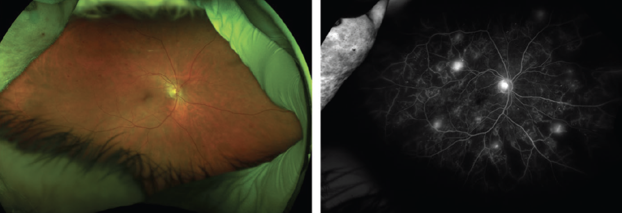 Managing DR One Case at a Time - Retina Today