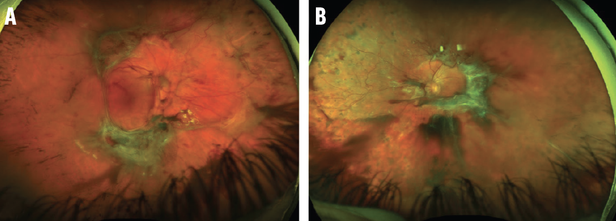 Managing DR One Case at a Time - Retina Today