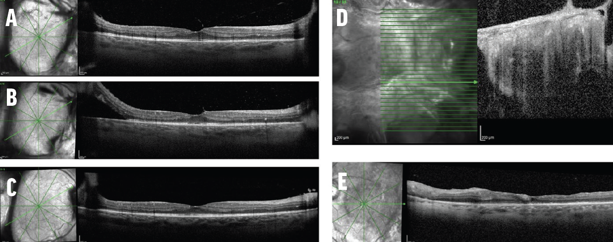 Managing DR One Case at a Time - Retina Today