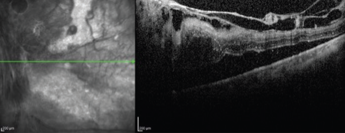 Tips for a Successful Diabetic TRD Surgery - Retina Today