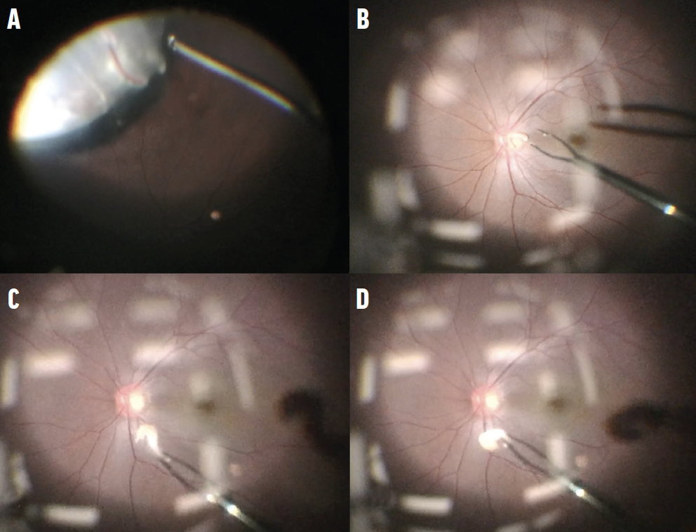 A ‘Serous’ Floater - Retina Today