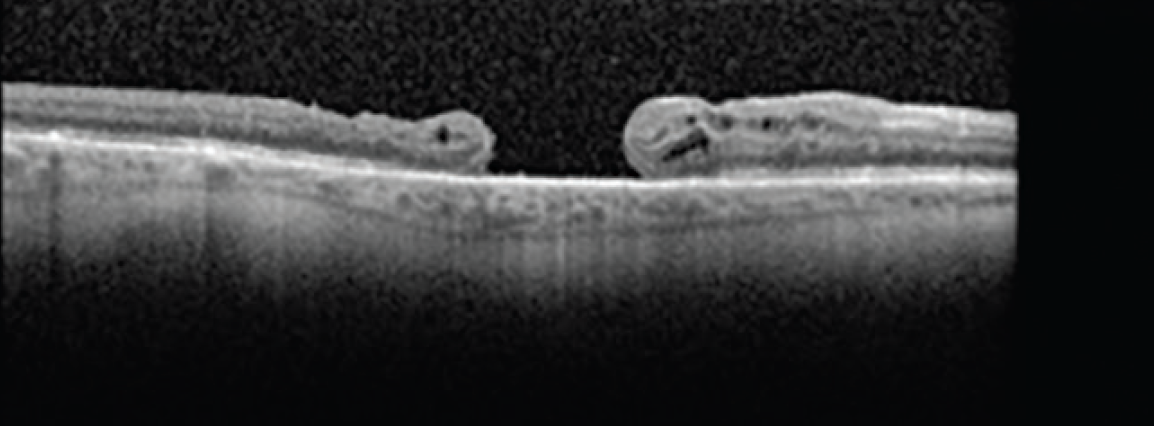 Surgical Options for Refractory Macular Holes - Retina Today