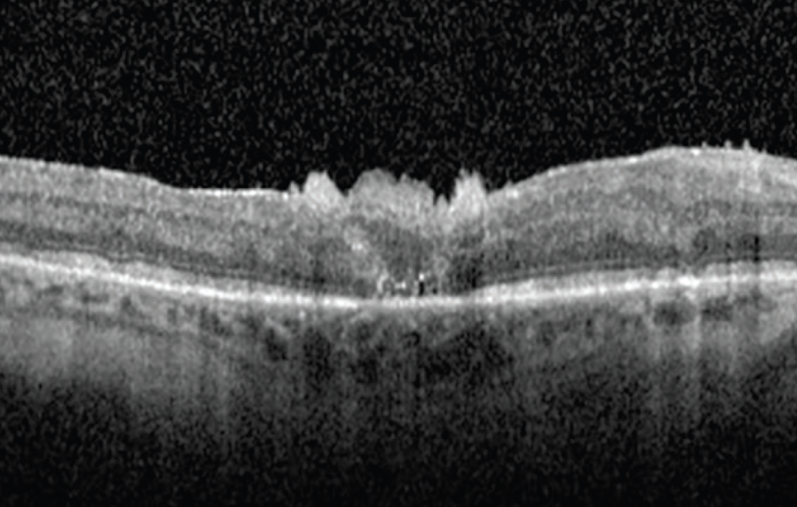 Surgical Options for Refractory Macular Holes - Retina Today