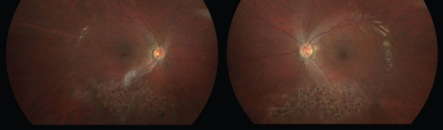 An Unusual Case of Pigmentary Retinopathy - Retina Today