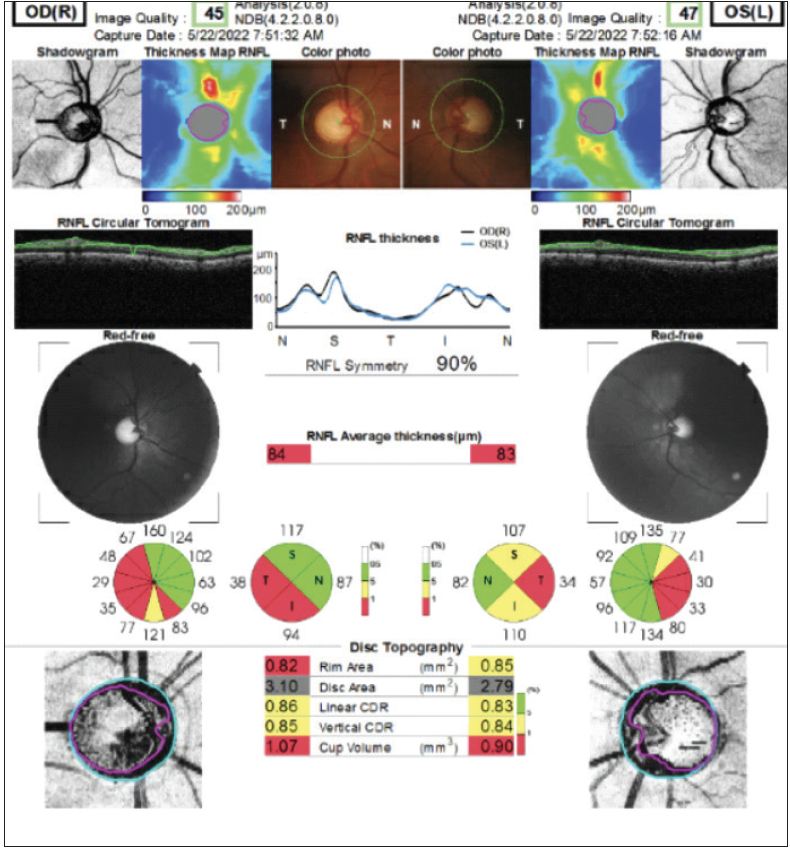 Incidental Glaucoma Screening Using Teleophthalmology at a Tertiary ...