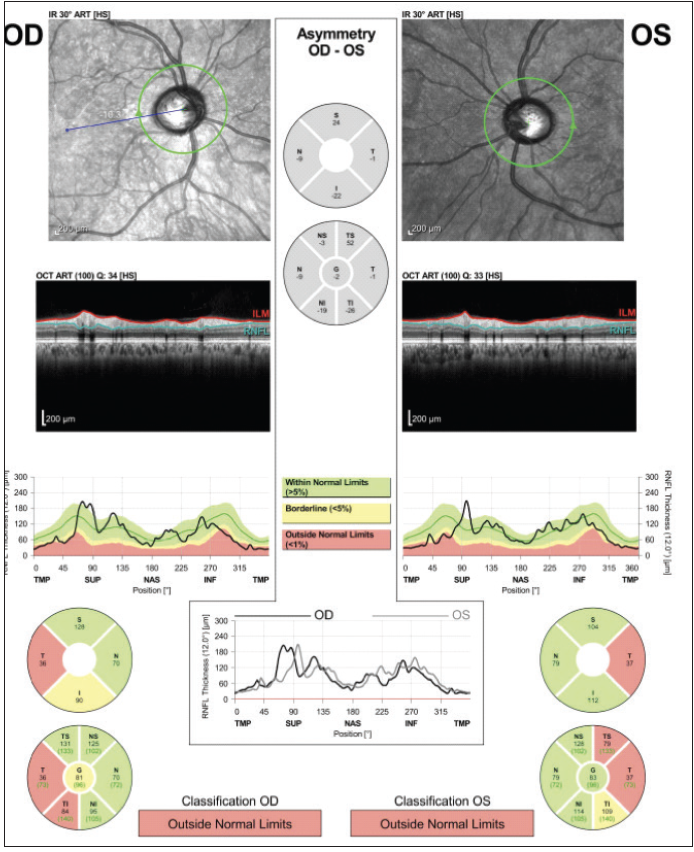 Incidental Glaucoma Screening Using Teleophthalmology at a Tertiary ...