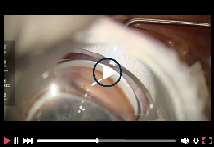 The Buzz on Eyetube - Glaucoma Today