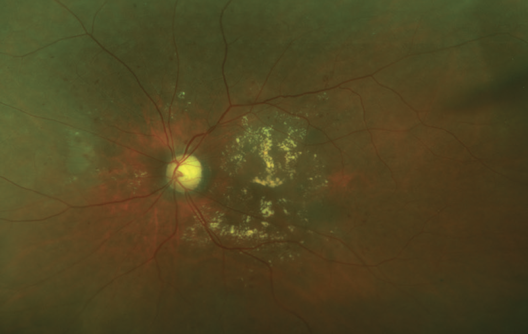 DR Research Roundup: Phase 2 and 3 - Retina Today