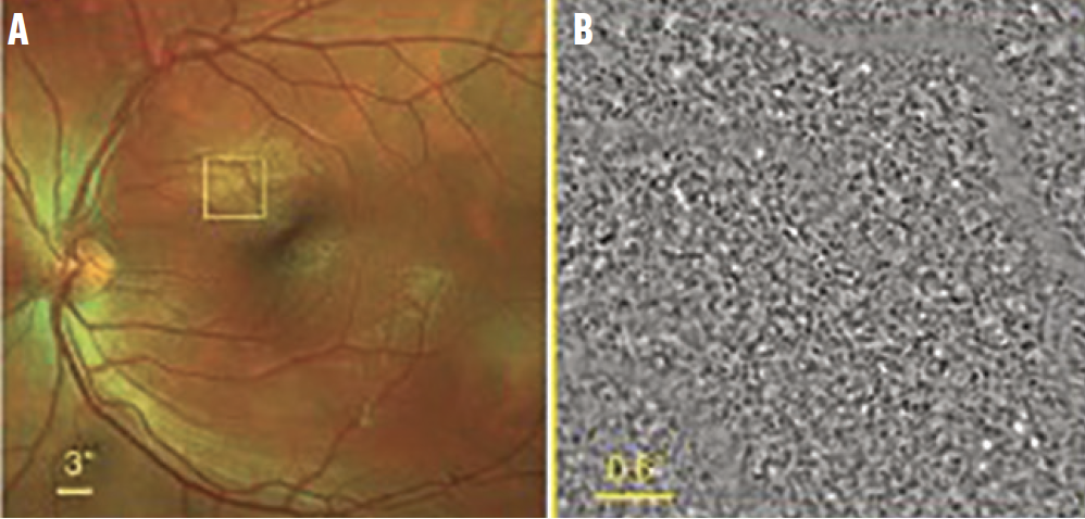 Retinal Imaging Pipeline Updates - Retina Today