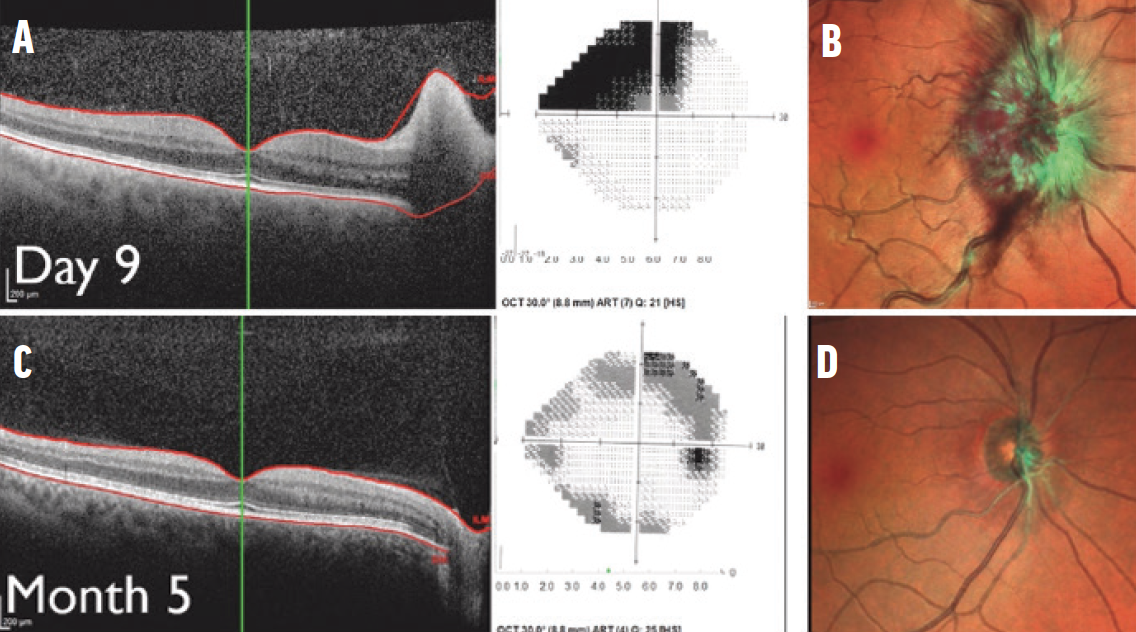 Defining Ocular Ischemic Processes: An Atlas - Retina Today