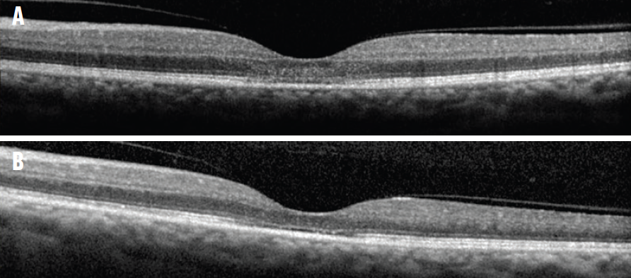 A Toxic Side Effect of Dropless Surgery - Retina Today
