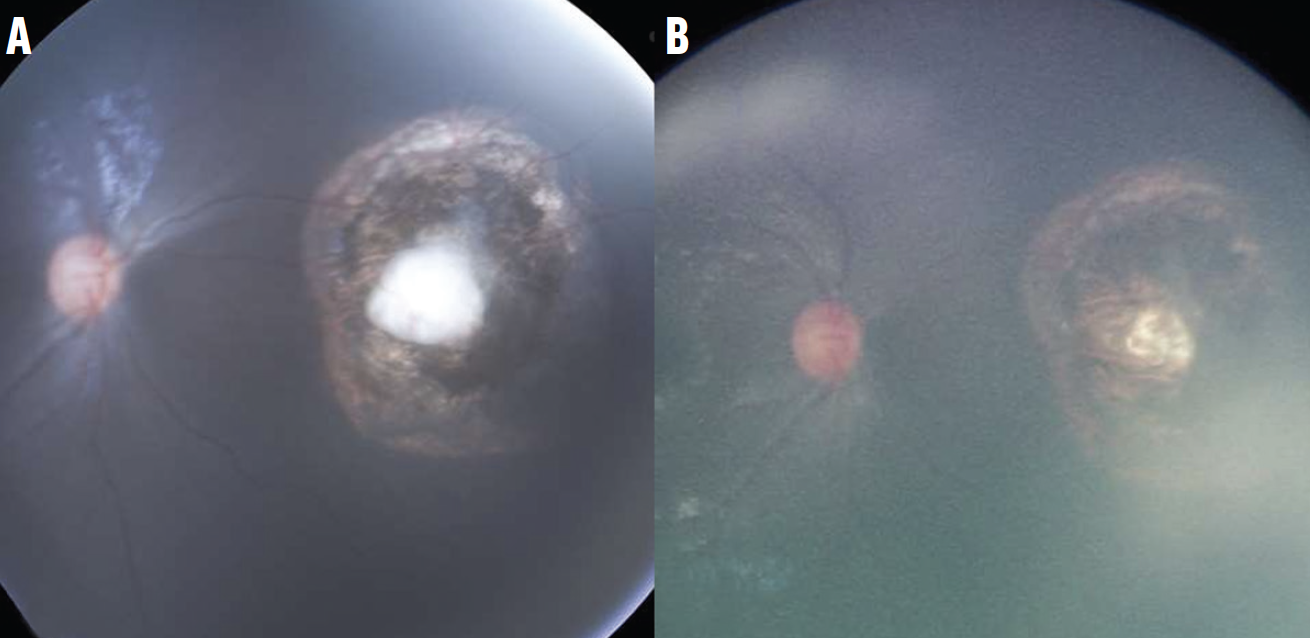Intraarterial Chemotherapy for Recurrent Retinoblastoma - Retina Today