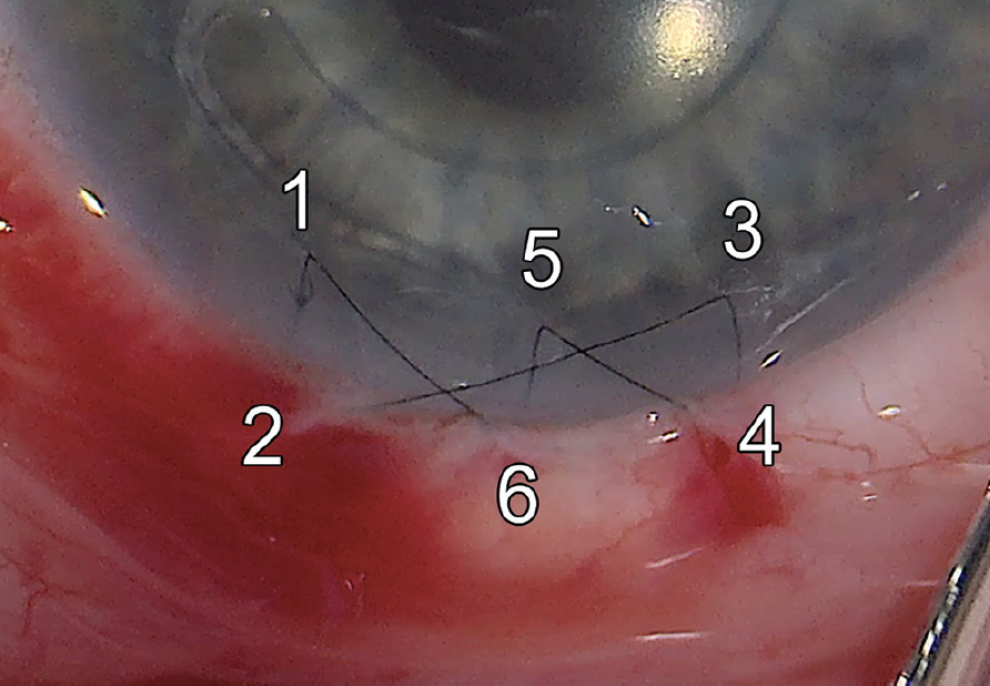 Secondary IOLs Four Ways - Retina Today
