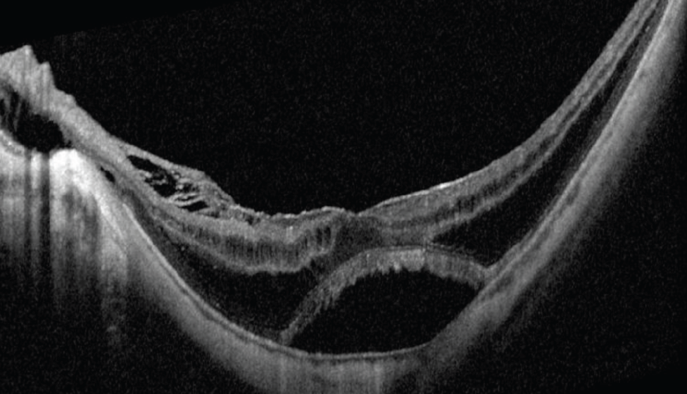 Unconventional Buckling Techniques: Controlling MTM - Retina Today