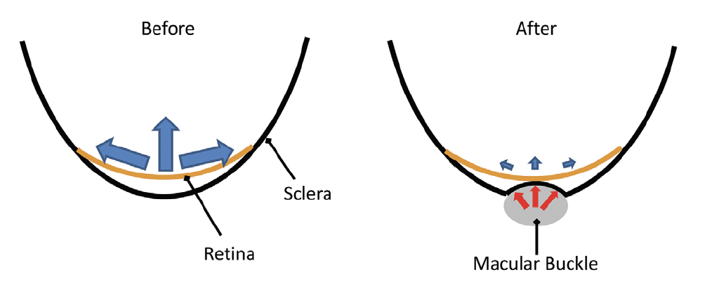 Unconventional Buckling Techniques: Controlling MTM - Retina Today