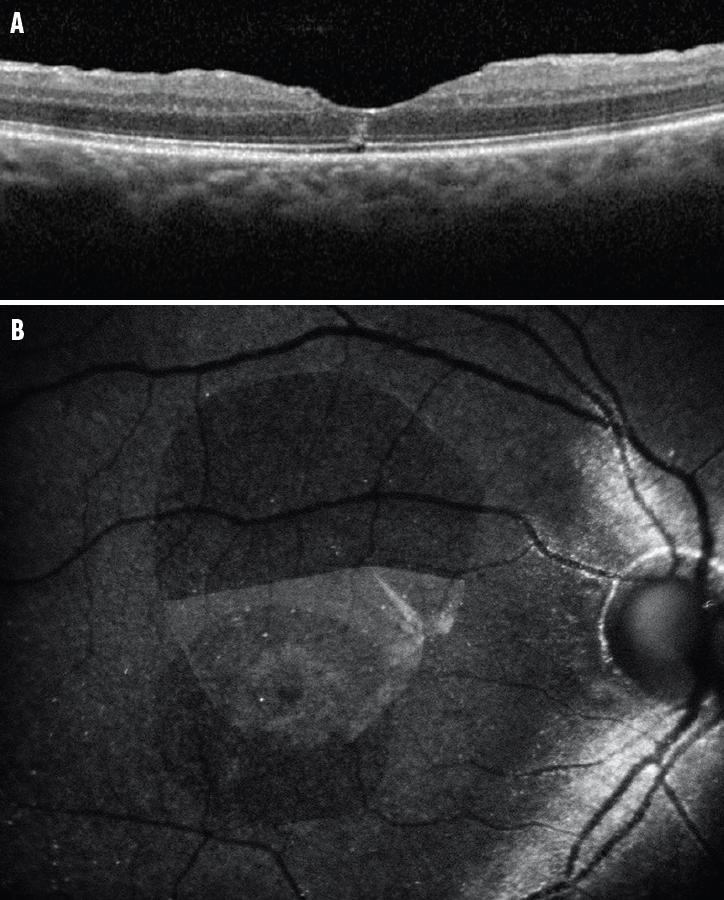 A SWIFT Approach to Macular Holes - Retina Today