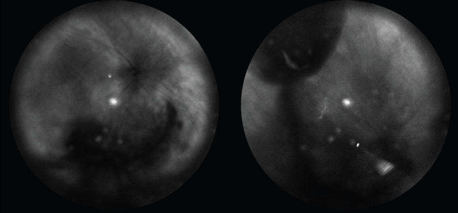 Vitreous Hemorrhage: Observe or Operate? - Retina Today
