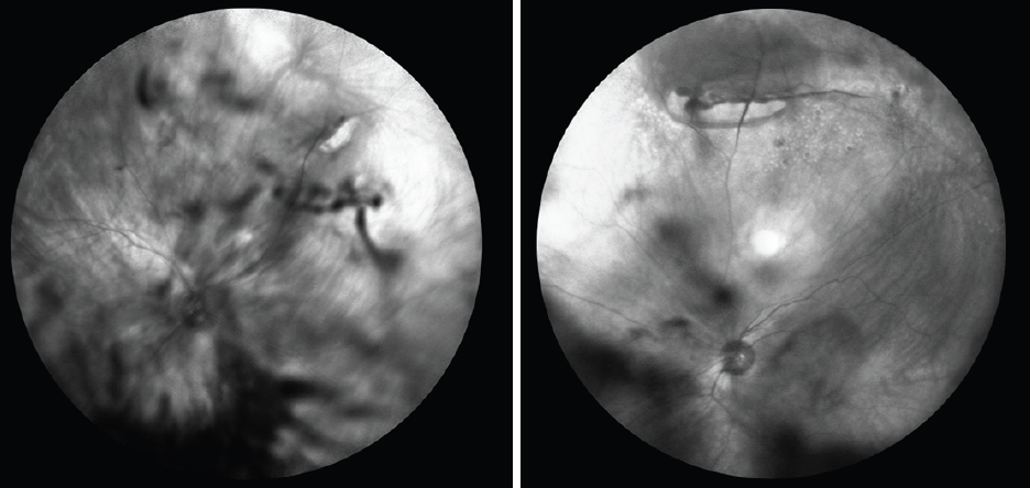 Vitreous Hemorrhage: Observe or Operate? - Retina Today