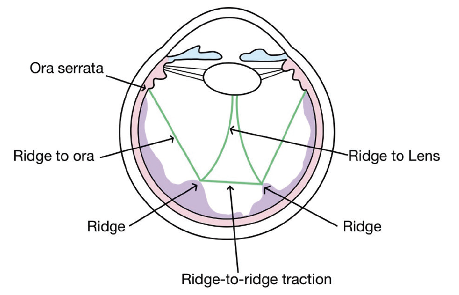 ROP in the OR: When Less is More - Retina Today