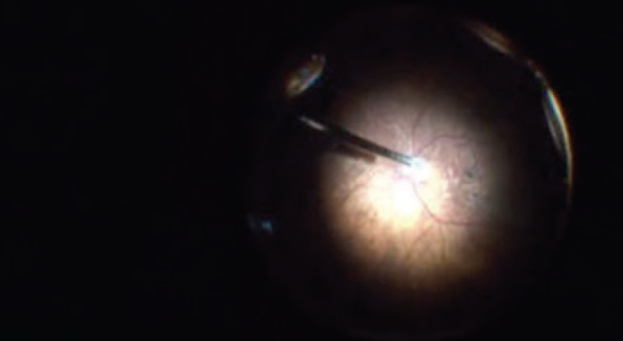 Macular Hole Surgery Roundup - Retina Today