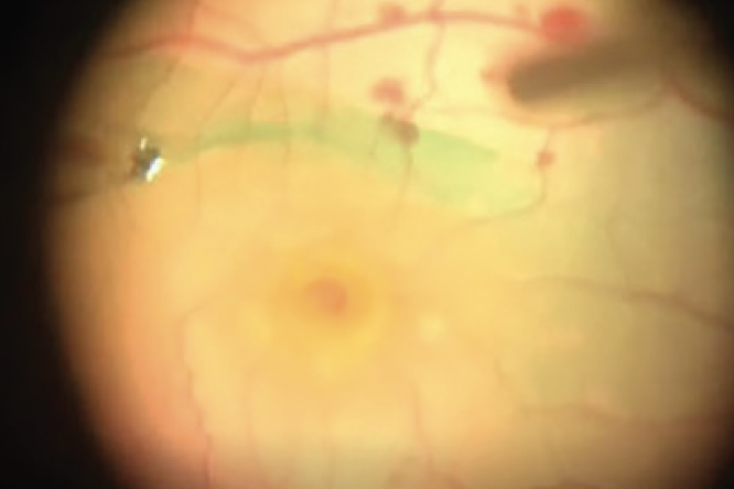 Macular Hole Surgery Roundup - Retina Today