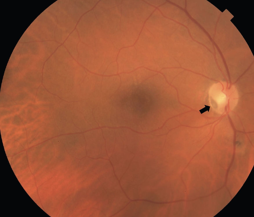 Optic Disc Pit Maculopathy Today s Treatment Options Retina Today