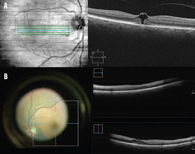 Five Ways OCT Can Enhance Vitreoretinal Surgery - Retina Today