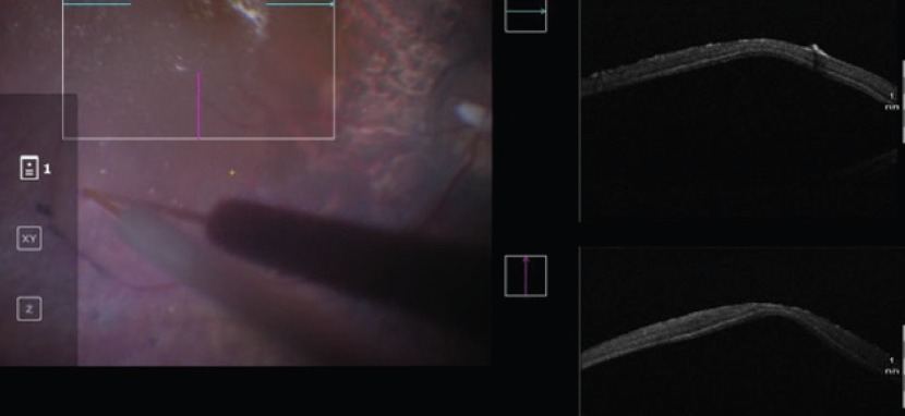 Five Ways OCT Can Enhance Vitreoretinal Surgery - Retina Today