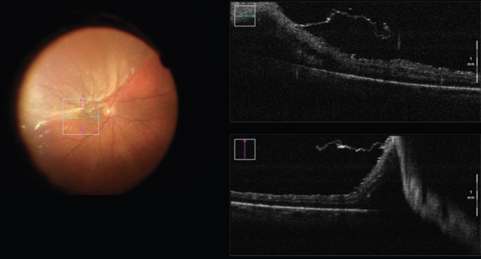 Five Ways OCT Can Enhance Vitreoretinal Surgery - Retina Today