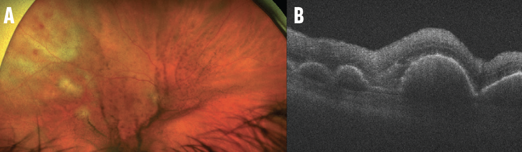 Master the Vitreoretinal Biopsy Basics - Retina Today