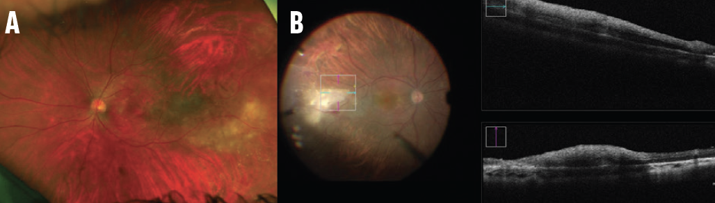 Master the Vitreoretinal Biopsy Basics - Retina Today