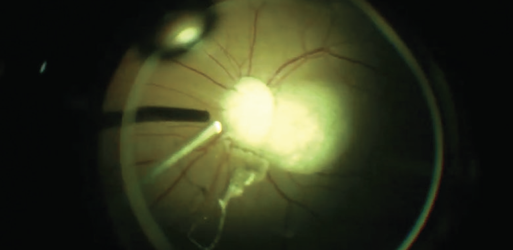 Chromovitrectomy: A Primer - Retina Today