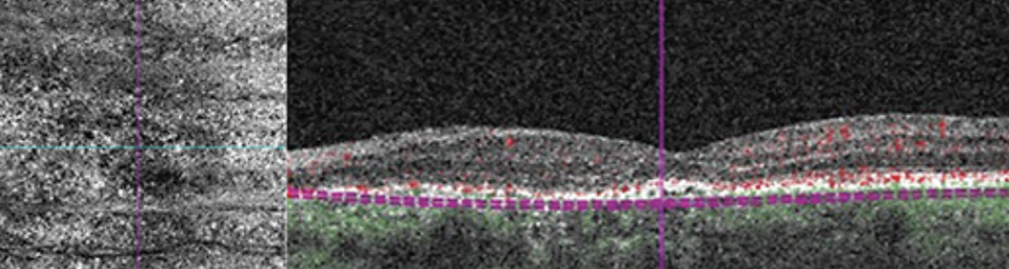Identifying AMD Overlap Syndromes - Retina Today