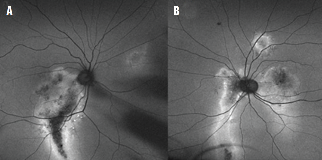 Identifying AMD Overlap Syndromes - Retina Today