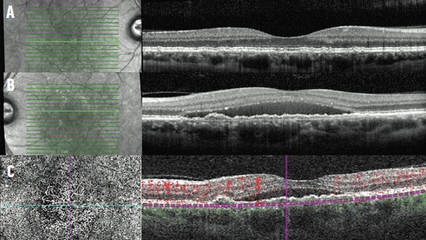 Identifying AMD Overlap Syndromes - Retina Today
