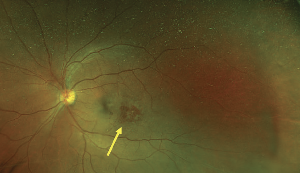 It Takes a Village to Make a Diagnosis - Retina Today