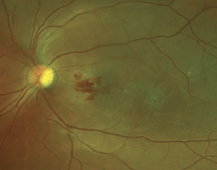 It Takes a Village to Make a Diagnosis - Retina Today