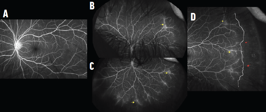 Diagnosing and Managing Pediatric Retinal Vasculitis - Retina Today