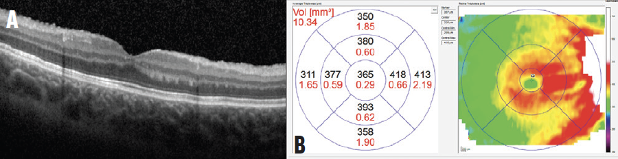 Diagnosing and Managing Pediatric Retinal Vasculitis - Retina Today