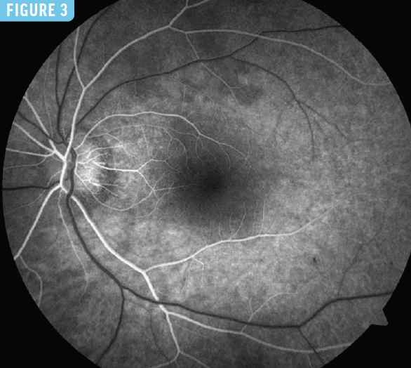The Case of the Enormous Blind Spot - Retina Today