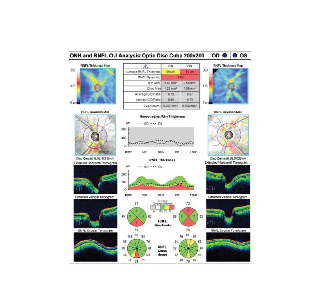 Recurrent Hyphema Part 2 - Glaucoma Today