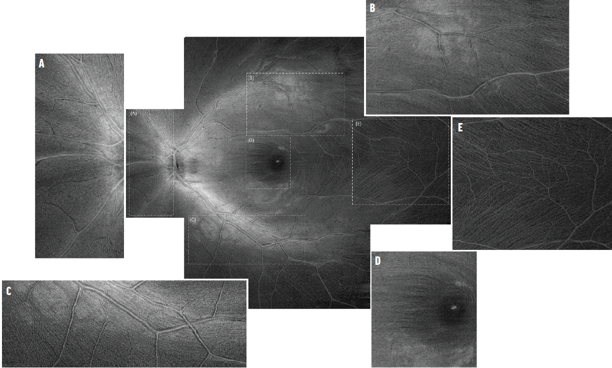 Retinal Nerve Fiber Layer Optical Texture Analysis - Glaucoma Today
