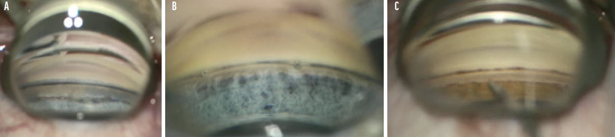 First 50 MIGS Procedures as a Glaucoma Fellow - Glaucoma Today