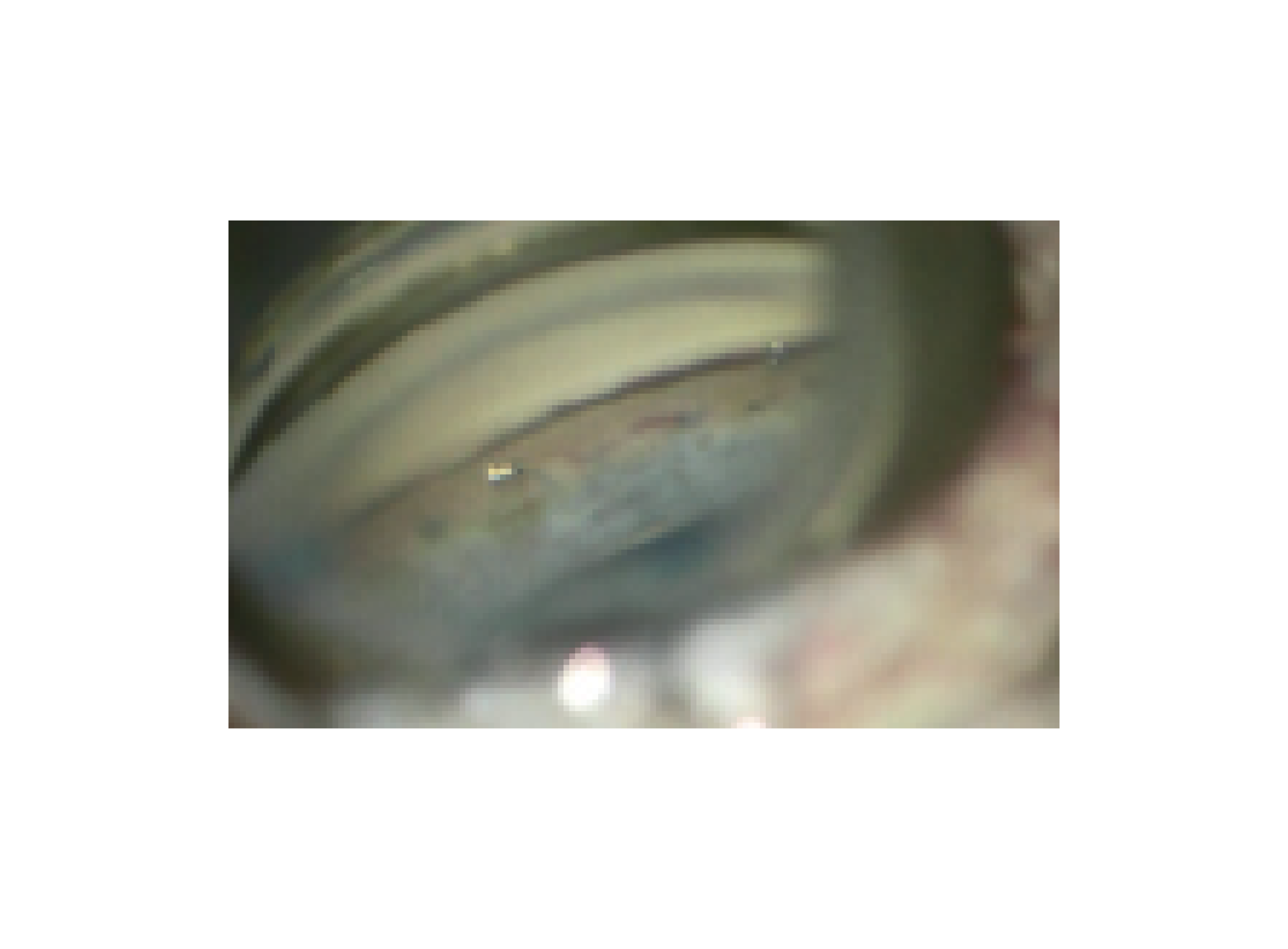 First 50 MIGS Procedures as a Glaucoma Fellow - Glaucoma Today